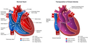 Transposition of the Great Arteries (TGA) - Cardiothoracic Surgery