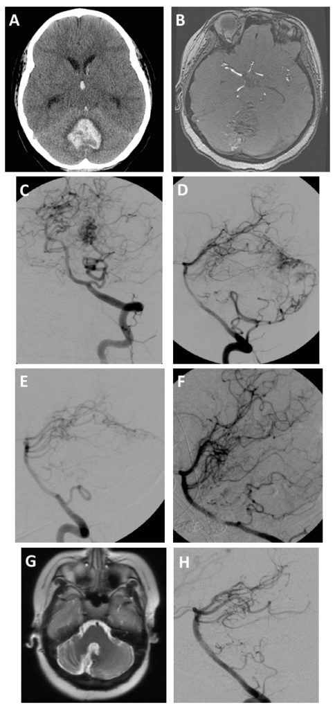 Arteriovenous Malformations - Neurosurgery