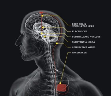 Parkinson's Disease - Neurosurgery