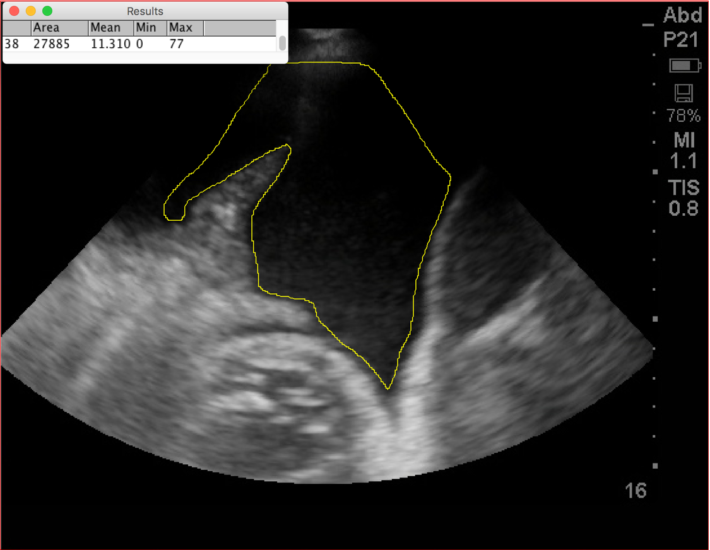 Echogenicity - Pulmonary Diseases and Critical Care